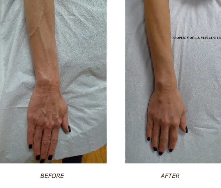 Hand Vein Treatment Los Angeles CA - Chest Veins Los Angeles