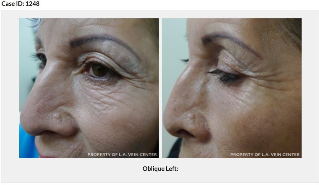 Radiesse injections Los Angeles - Synthetic Fillers Expert CA